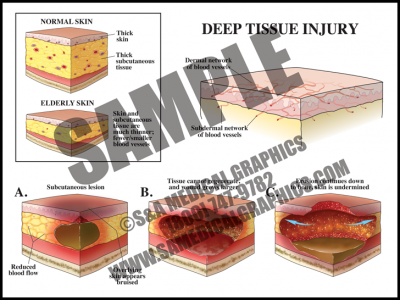 Decubitus Ulcer Formation - S&A Medical Graphics