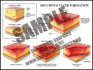 Decubitus Ulcer Formation - S&A Medical Graphics
