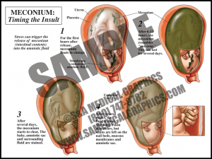 Forceps Delivery Animation - S&A Medical Graphics