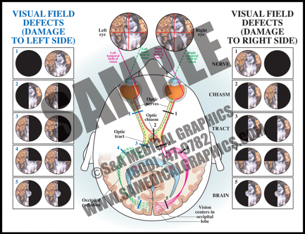 Visual Field Defects - S&A Medical Graphics