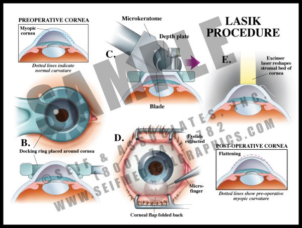 Cataract Surgery - S&A Medical Graphics