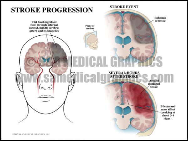 neurosurgical-complications-s-a-medical-graphics
