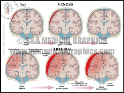 Neurosurgical Complications - S&A Medical Graphics