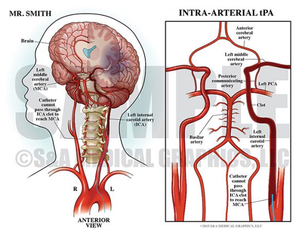 Stroke and tPA Case Study - S&A Medical Graphics