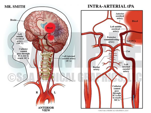 Stroke and tPA Case Study - S&A Medical Graphics