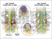 Lumbar Nerve Root Case Study - S&A Medical Graphics