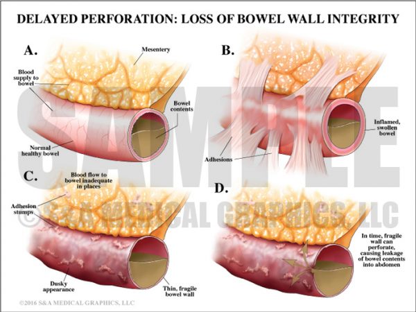 Adhesions Case Study - S&A Medical Graphics