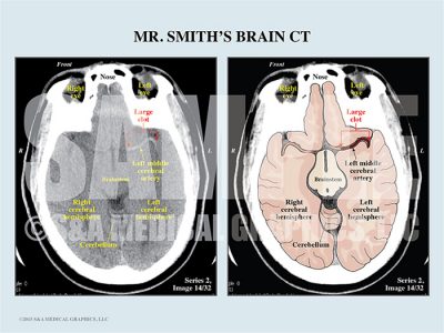 Stroke and tPA Case Study - S&A Medical Graphics