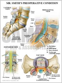 Lumbar Nerve Root Case Study - S&A Medical Graphics