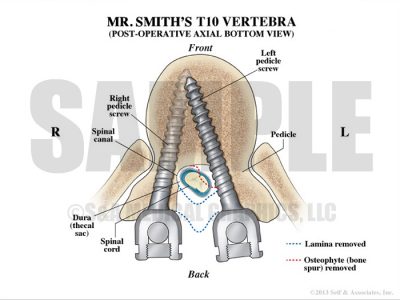 Thoracic Spine Fusion Case Study - S&A Medical Graphics