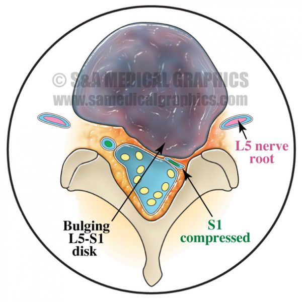 Lumbar Nerve Root Case Study - S&A Medical Graphics
