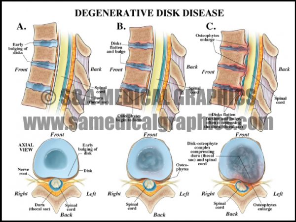 Spine Surgery - S&A Medical Graphics