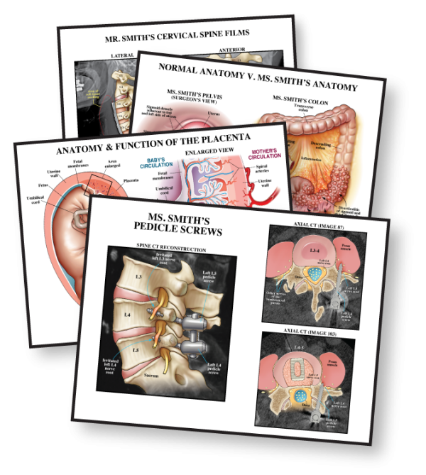 Medical Legal Illustrators - S&A Medical Graphics