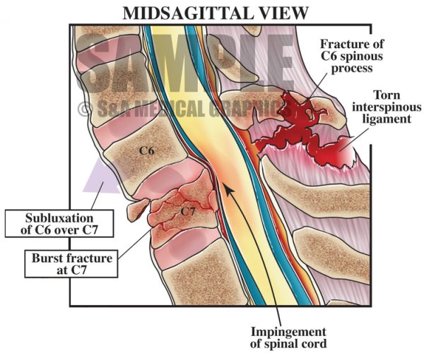 Cervical Spine Injury S A Medical Graphics Cervical Spine Injury S A Medical Graphics