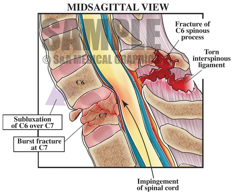 Cervical Spine Injury S A Medical Graphics Cervical Spine Injury S A Medical Graphics