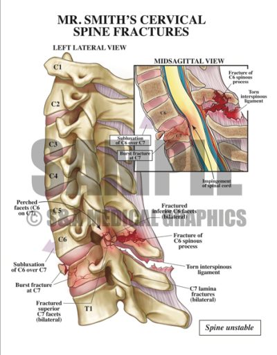 Cervical Spine Injury - S&A Medical Graphics