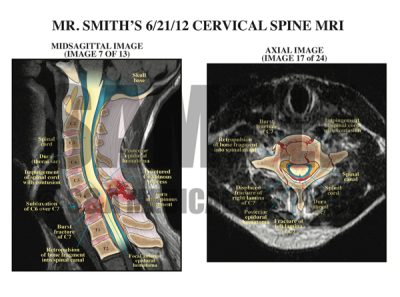 Cervical Spine Injury Archives - S&A Medical Graphics