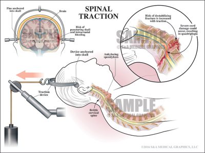 Cervical Injury Stabilization Archives - S&A Medical Graphics